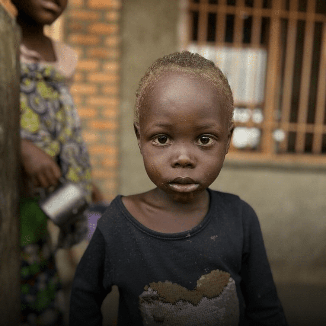 Siwe Włosy Dziecka - Skrajne Niedożywienie Nadal Istnieje: Historia ...