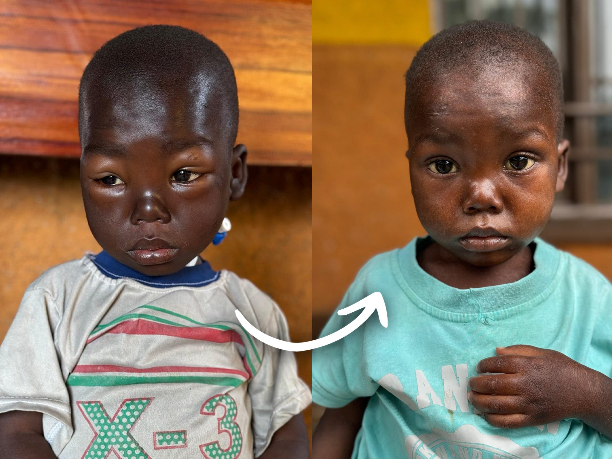 Thanks to Your Support, Joshua Is Recovering from Severe Malnutrition ...